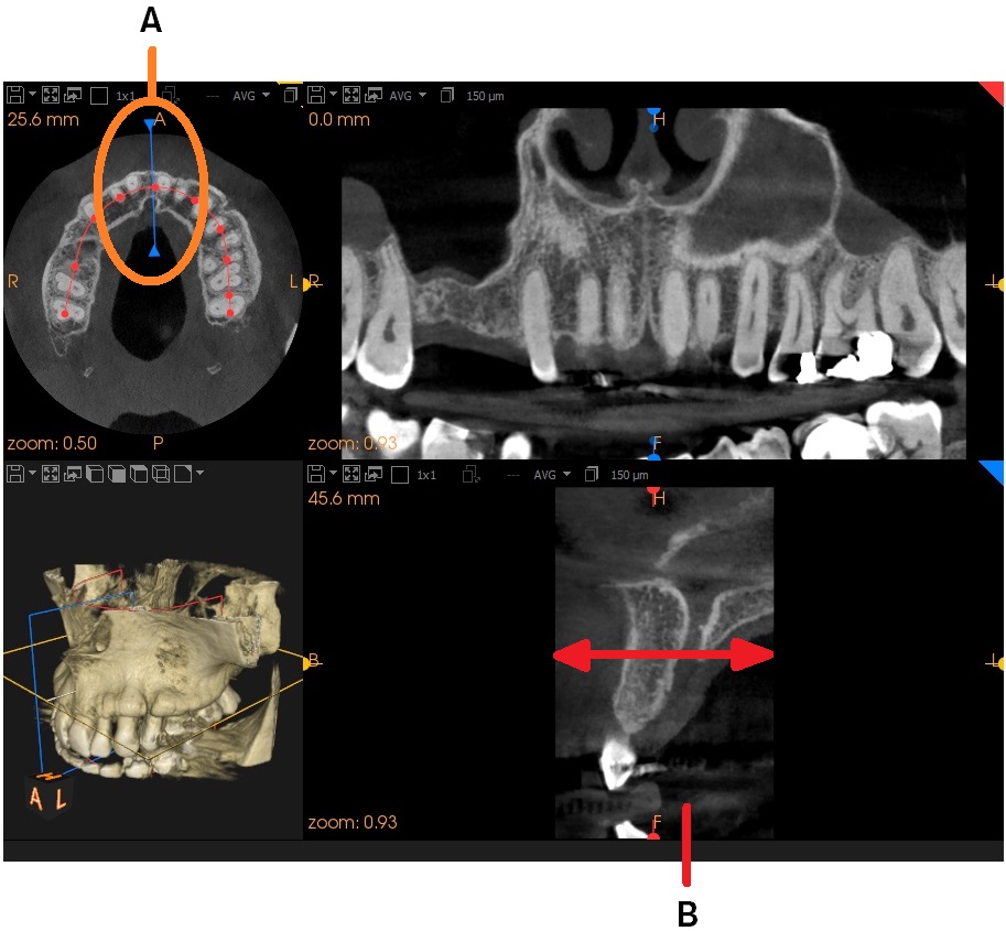 Adjusting the Width of Lateral View Screens