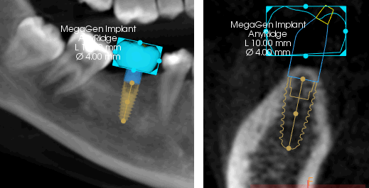 Using the Implant Object List to Edit Implants and Display Information