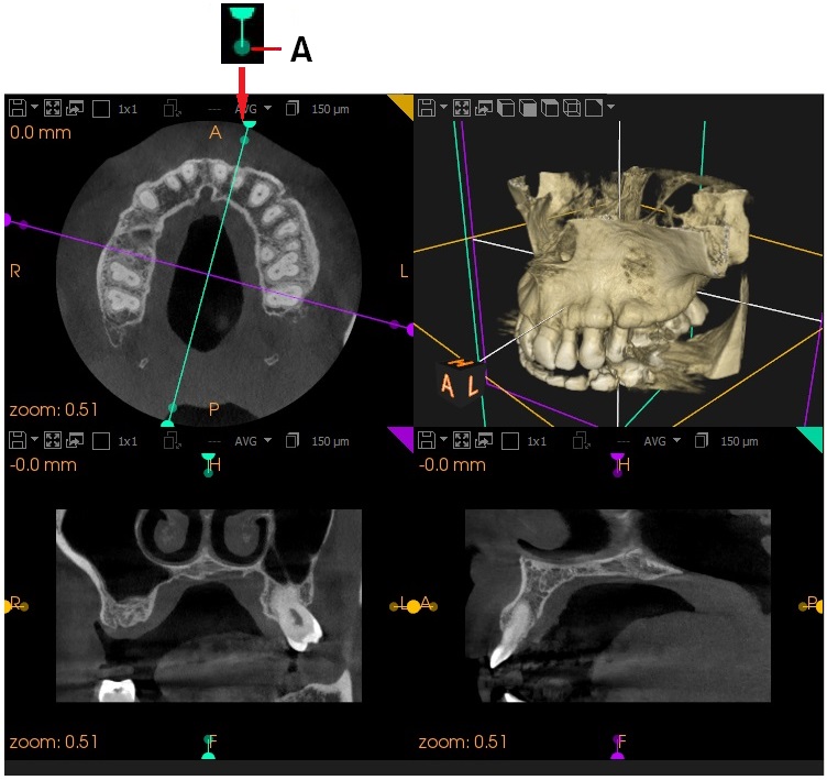 Tilting the Slice Planes in the MPR Tab