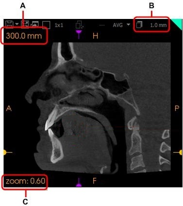 Understanding the Numerical Information on 2D MPR View Screens